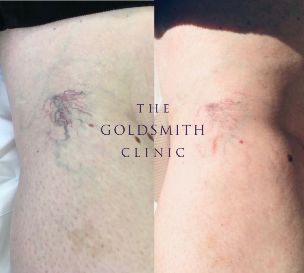 Thread Veins-Microsclerotherapy | The Goldsmith Clinic
