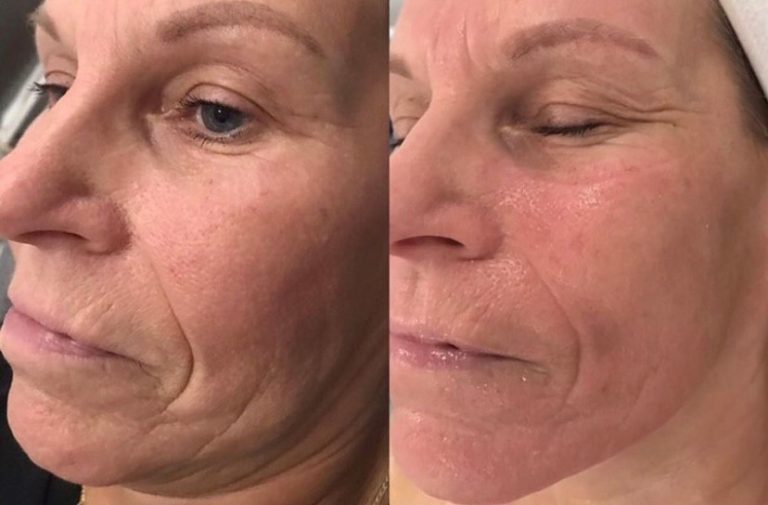SkinPen®Microneedling | The Goldsmith Clinic